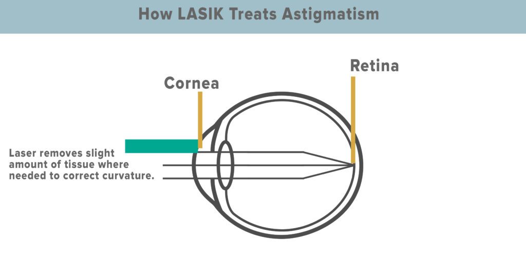 LASIK Portland | More Vision Correction Options and Customized Care