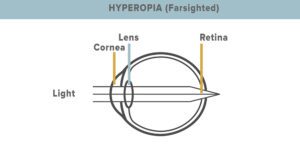 LASIK Portland | More Vision Correction Options and Customized Care
